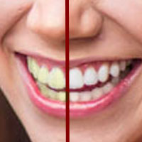 Teeth Whitening | Photo Editor for a Perfect Smile